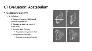 Acetabulum Fractures - Anatomy, Radiological Evaluation, Classification ...