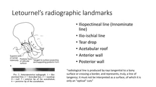 Acetabulum Fractures - Anatomy, Radiological Evaluation, Classification ...
