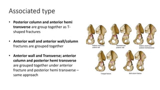 Acetabulum Fractures - Anatomy, Radiological Evaluation, Classification ...