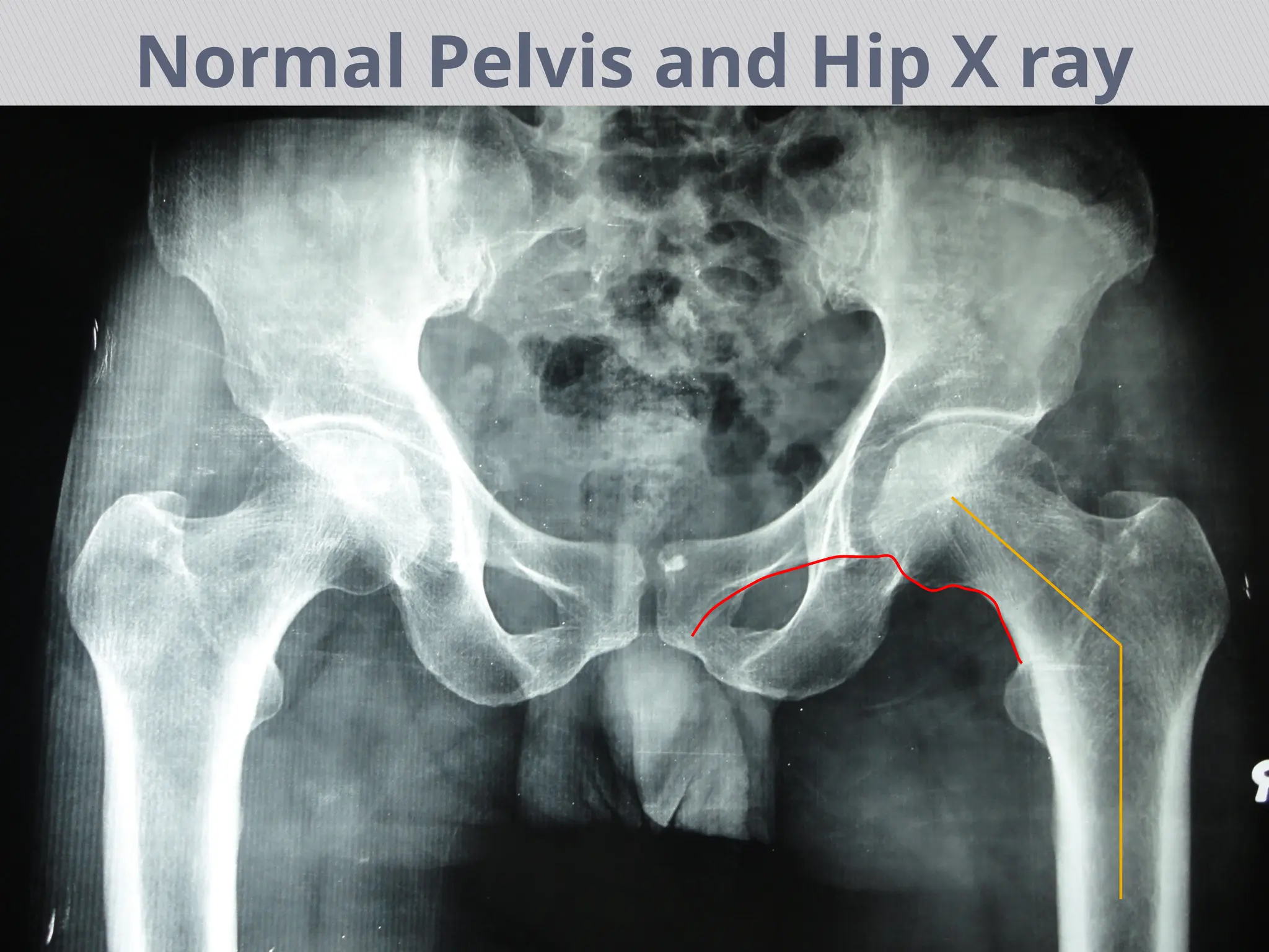 Acetabulum, Pelvis, Hip and femur ortho.pptx
