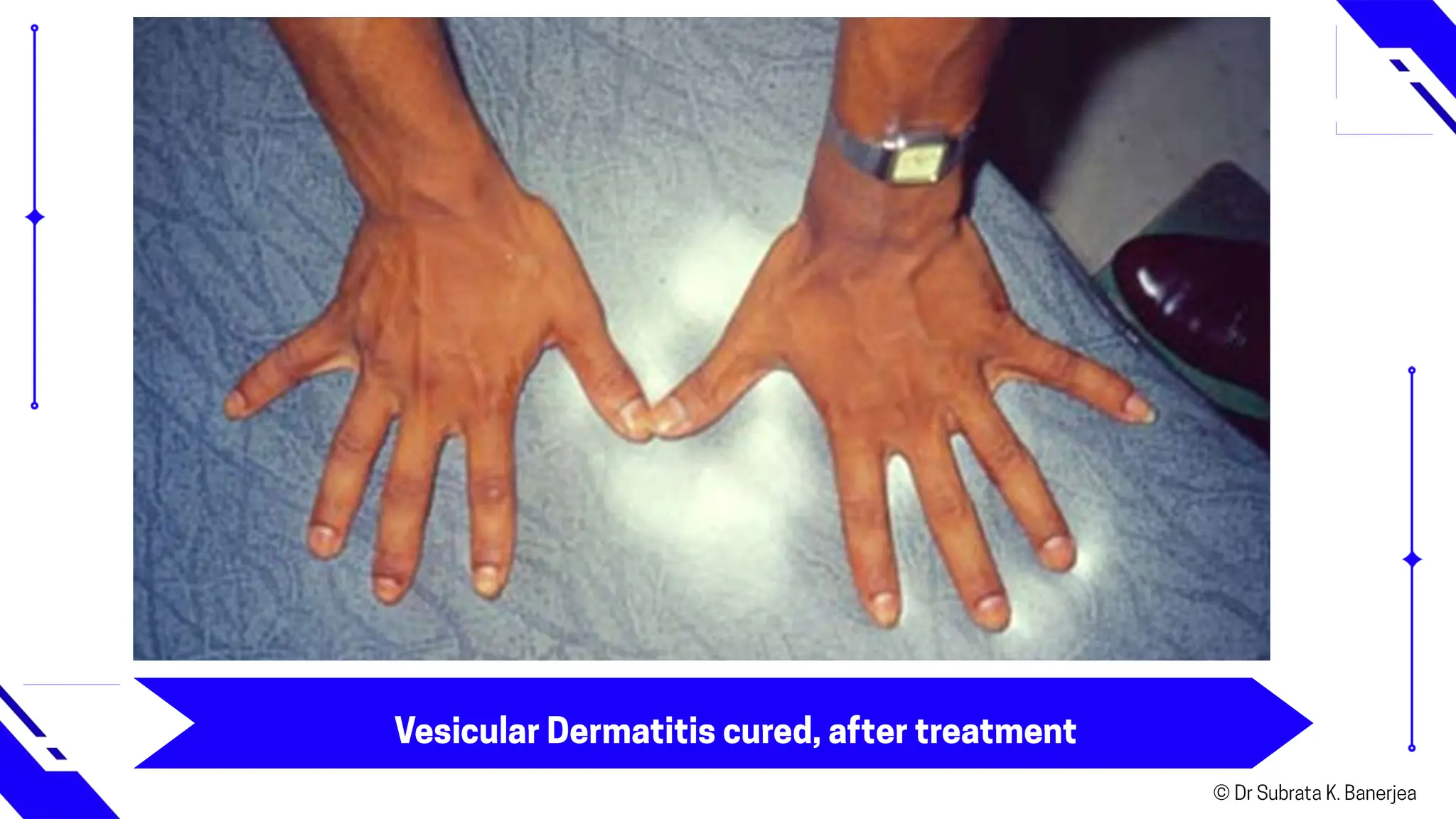 ACH - CURED CASE PPT - D010-ATOPIC VESICULAR DERMATITIS IN HAND-BM.pptx