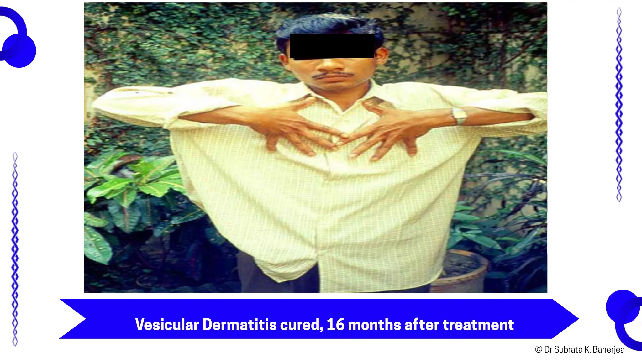 ACH - CURED CASE PPT - D010-ATOPIC VESICULAR DERMATITIS IN HAND-BM.pptx
