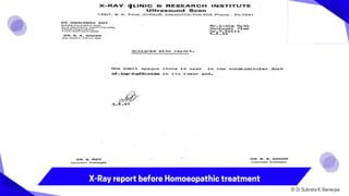 ACH - CURED CASE PPT - GA015-SUB-MANDIBULAR DUCT CALCULI-AN.pptx