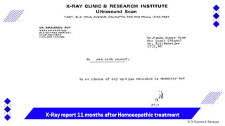 ACH - CURED CASE PPT - GA015-SUB-MANDIBULAR DUCT CALCULI-AN.pptx