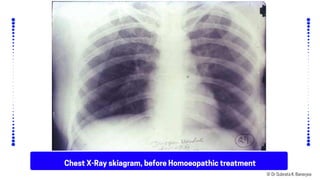 ACH - CURED CASE PPT - RE006-PULMONARY KOCH_S WITH BRONCHOSPASM-DM.pptx