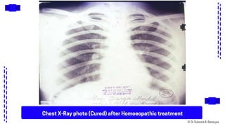 ACH - CURED CASE PPT - RE006-PULMONARY KOCH_S WITH BRONCHOSPASM-DM.pptx