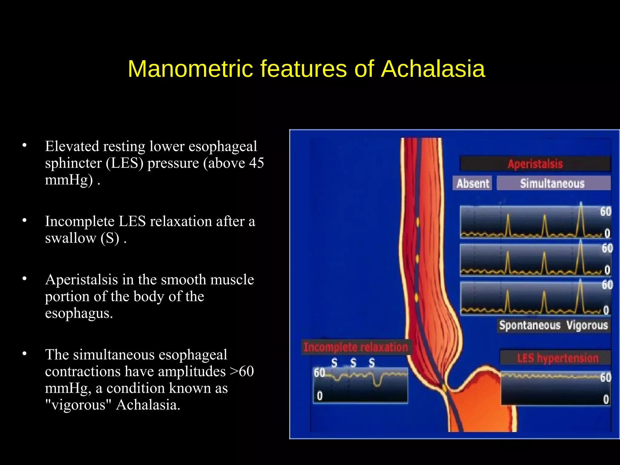 Achalasia | PPT