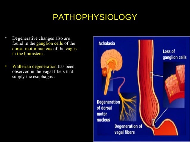 Achalasia