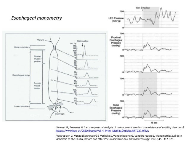 Achalasia