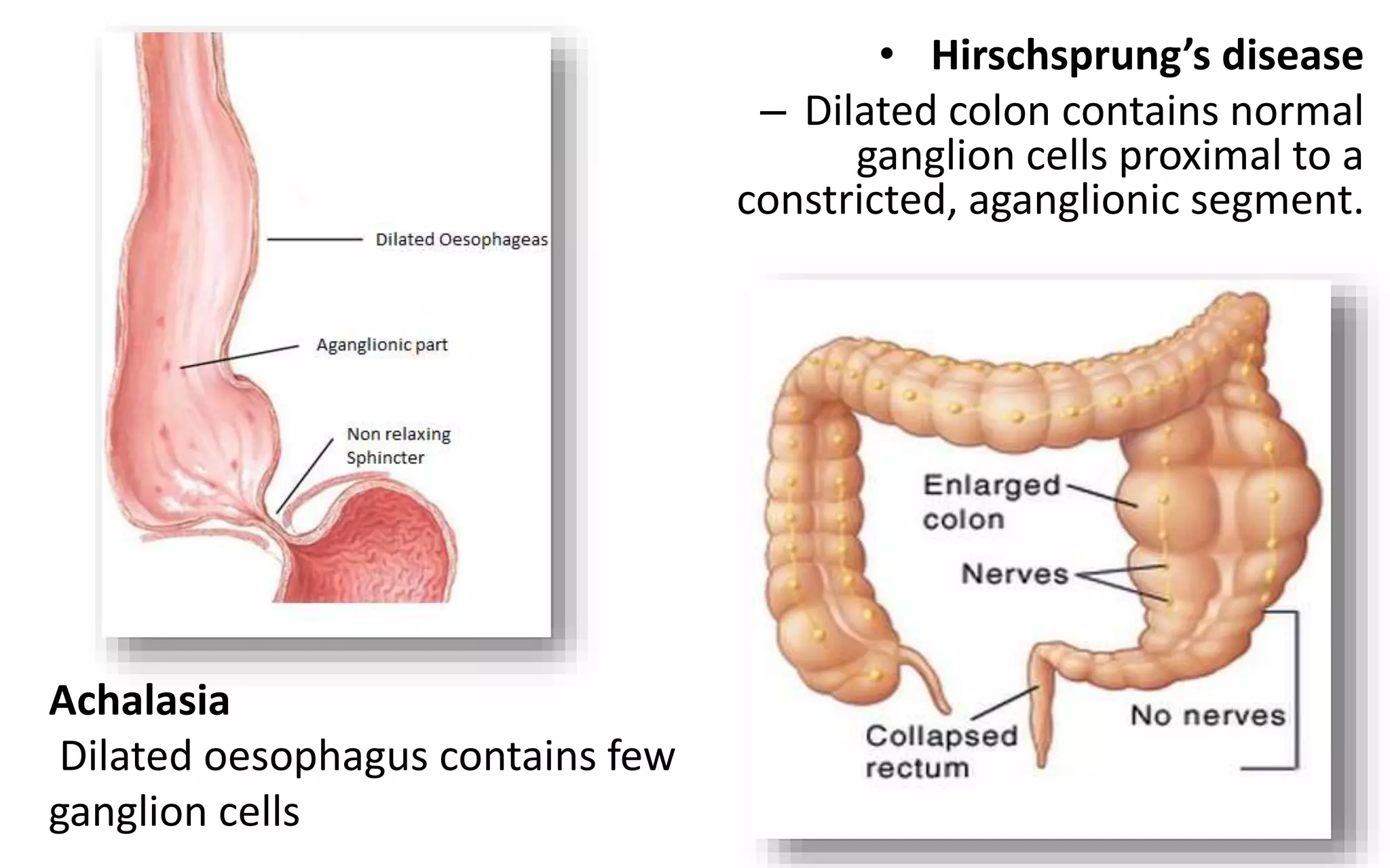 Achalasia | PPTX