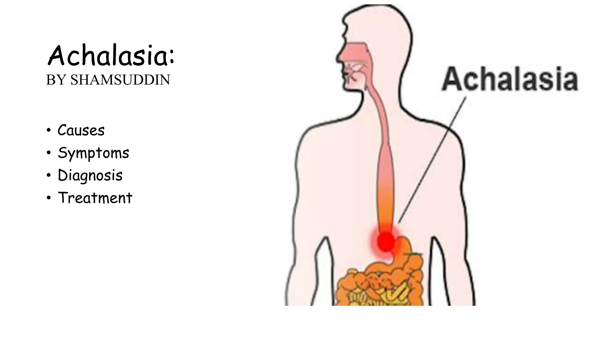 Achalasia .pptx