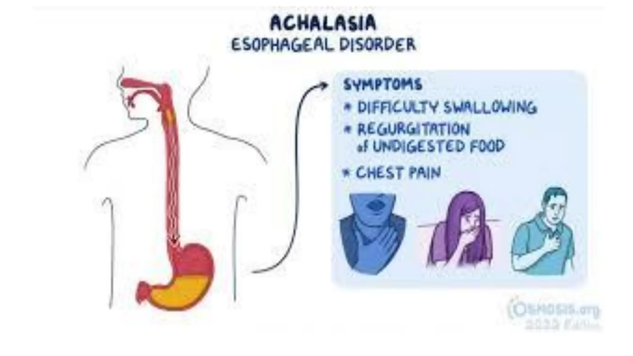 ACHALASIA. condition of gastrointestinal tract | PDF