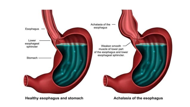 ACHALASIA. condition of gastrointestinal tract | PDF