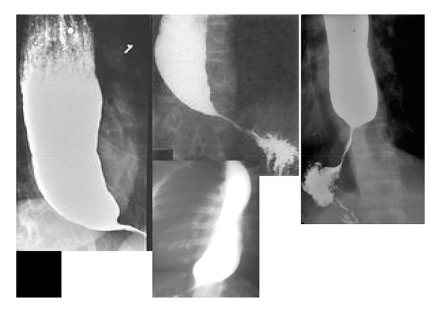Achalasia cardia | PPT