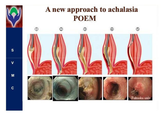 Achalasia cardia