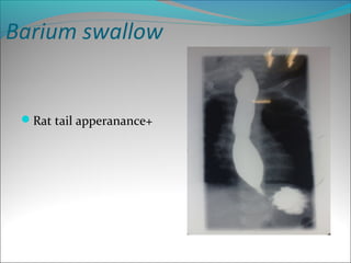 Achalasia cardia 2003 | PPT