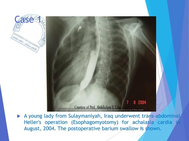 Achalasia Cardia Short Case Series.pdf