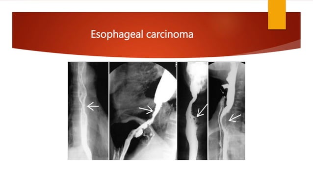 achalasia of cardia.pptxmmmmmmmmmmmmmmmm | PPT