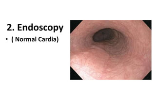 Achasia Cardia.pptx