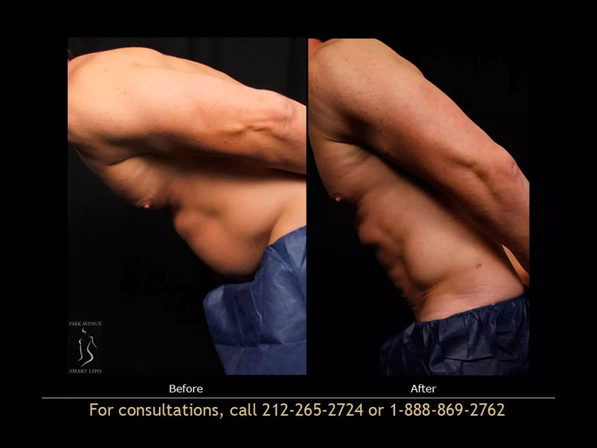 Achieve a truly masculine look with abdomen liposuction using smartlipo triplex | PPTX