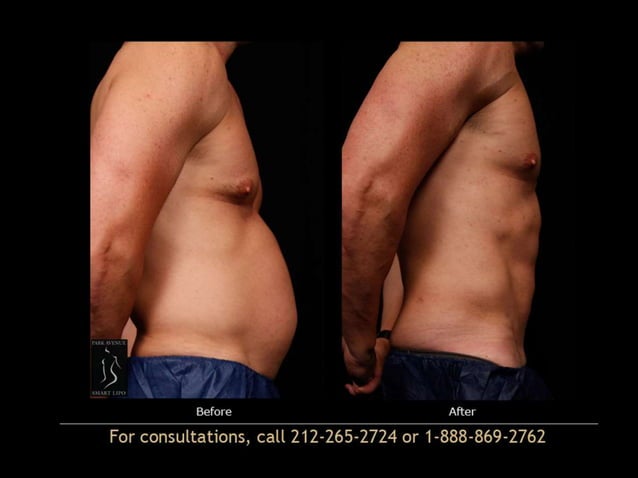 Achieve a truly masculine look with abdomen liposuction using smartlipo triplex | PPTX