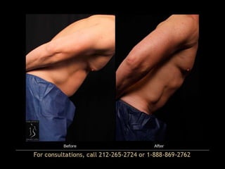 Achieve a truly masculine look with abdomen liposuction using smartlipo ...