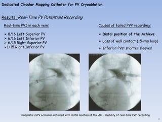 The Use of Achieve Circular Mapping Catheter Significantly Reduces ...