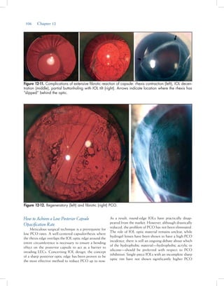 Achieving Excellence in Cataract Surgery | PDF