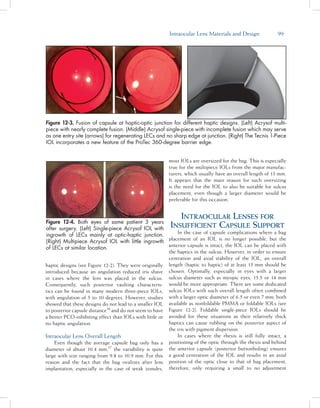 Achieving Excellence in Cataract Surgery | PDF | Eye and Vision ...