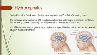 A child with a Large head | PPT