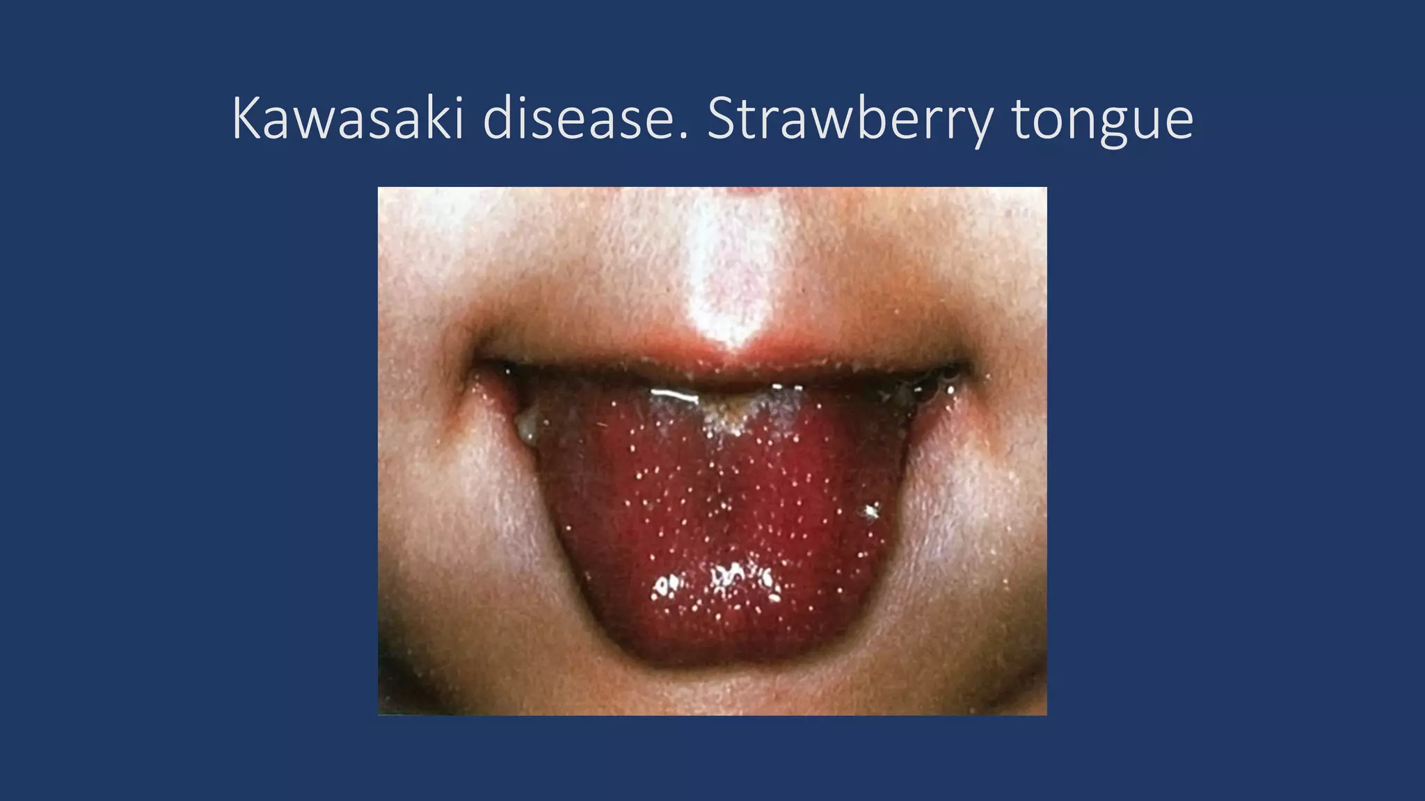 A CHILD WITH INCOMPLETE KAWASAKI DISEASE (4).pptx