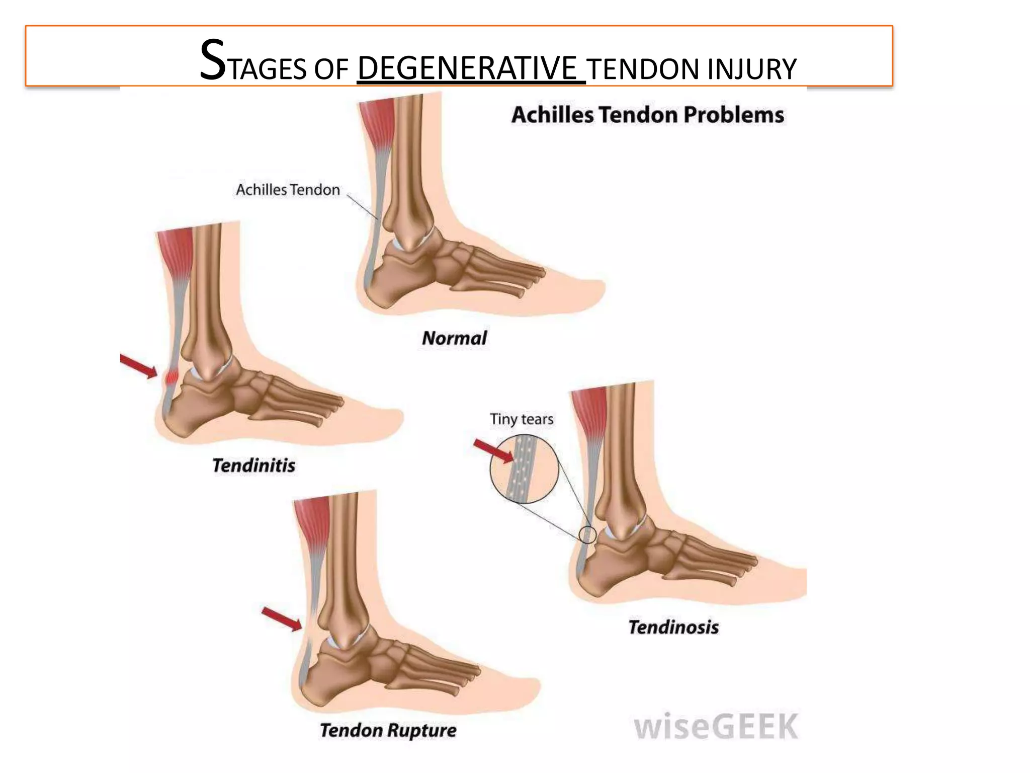 Achilis tendon rupture | PPTX