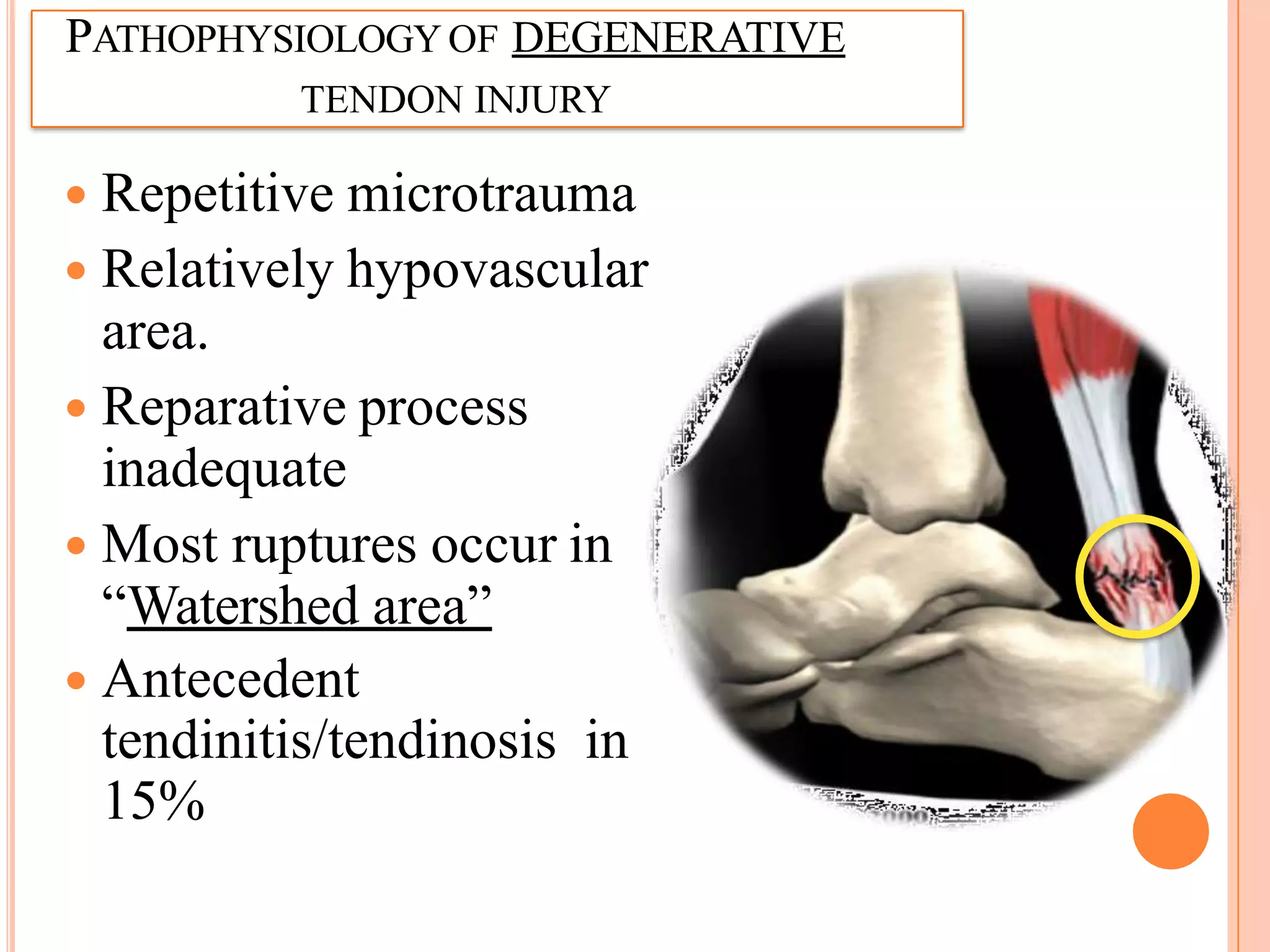 Achilis tendon rupture | PPTX