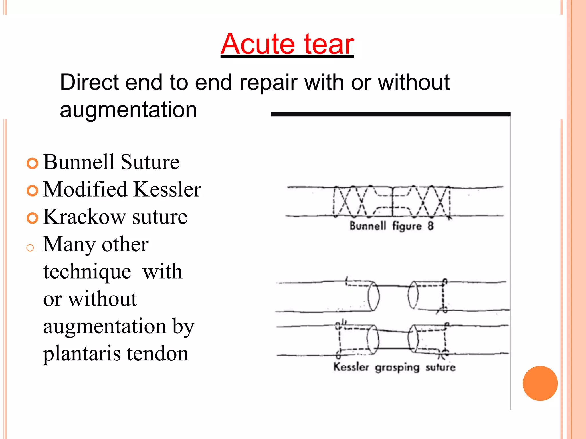 Achilis tendon rupture | PPTX
