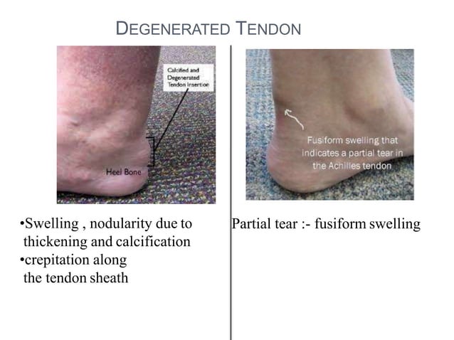 Achilis tendon rupture | PPT