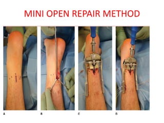 Achilis tendon rupture | PPTX