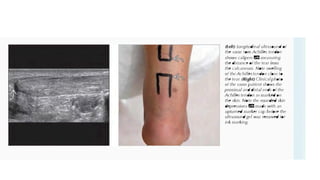 Achilles tendon pathology and trauma radiology | PDF