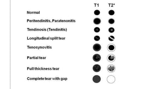 Achilles tendon pathology and trauma radiology | PDF