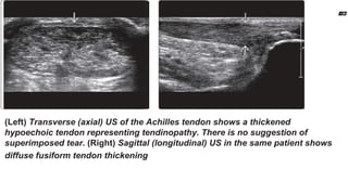 Achilles tendon pathology and trauma radiology | PDF