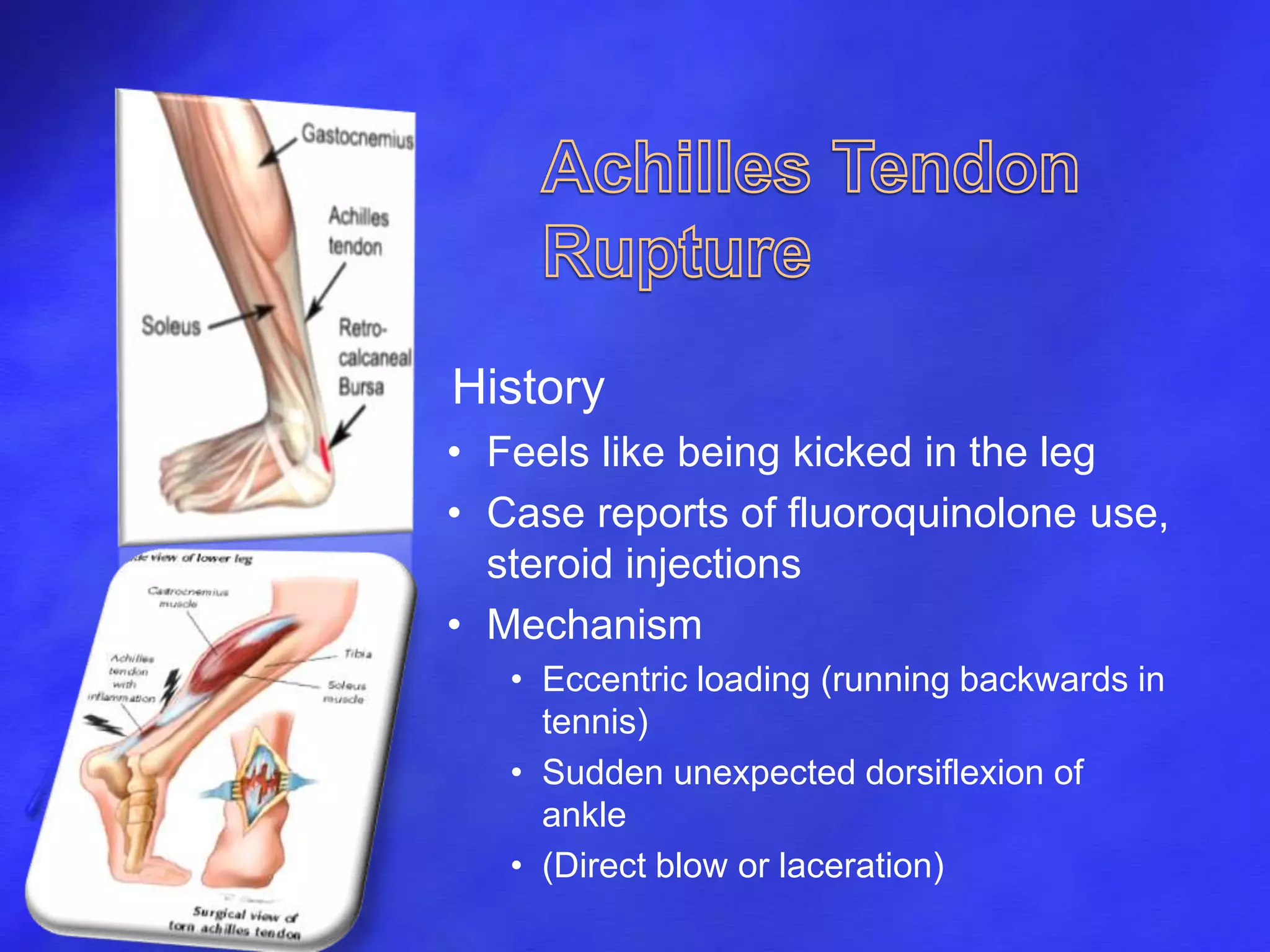 Achilles rupture | PPTX