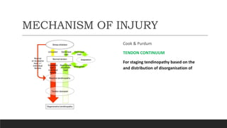 Achilles tendinopathy | PPTX