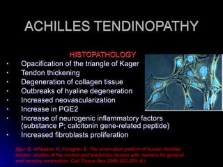 Achilles tendinopathy treatment with triple therapy | PDF
