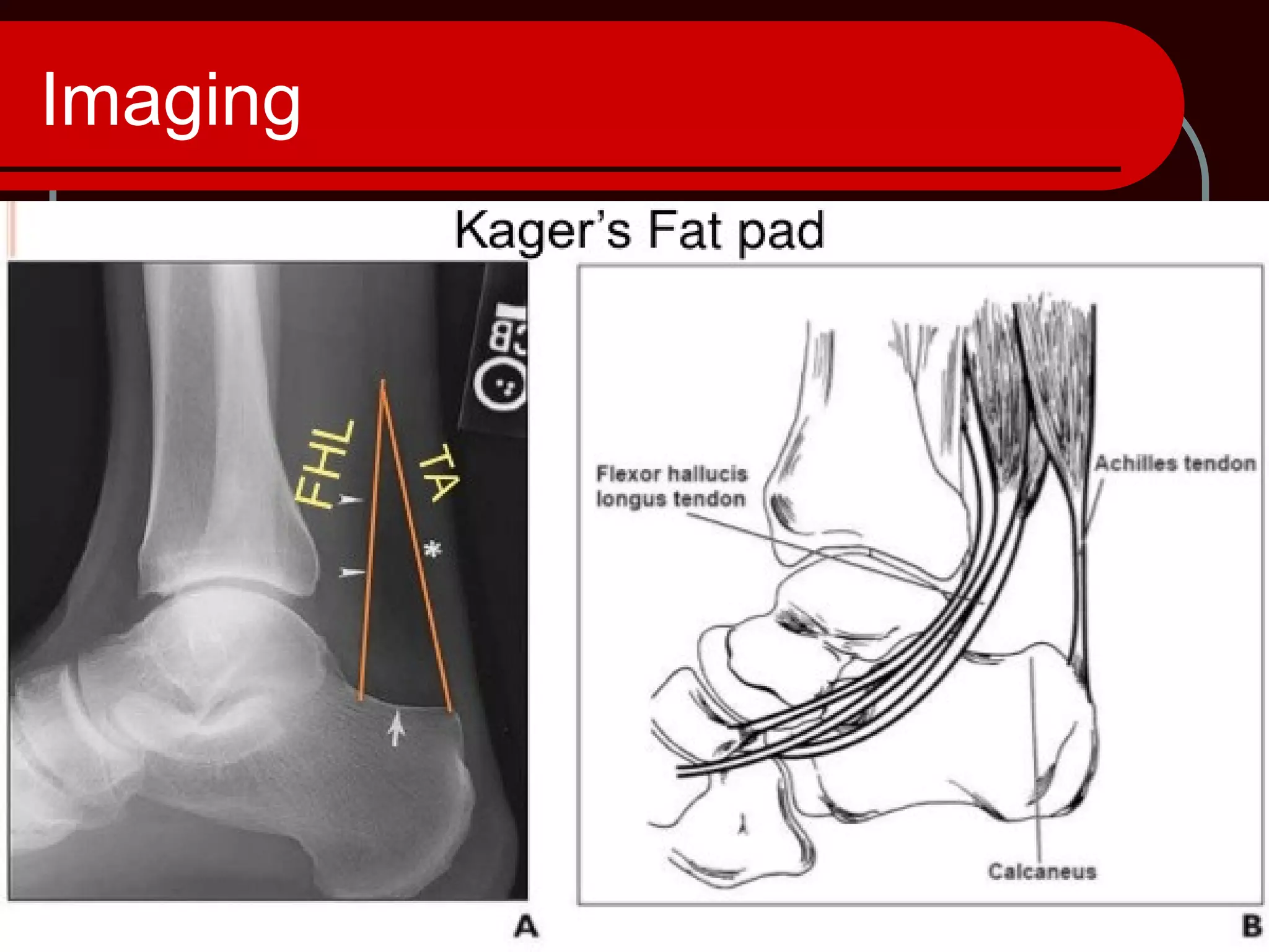 Achilles tendon pathology | PPT