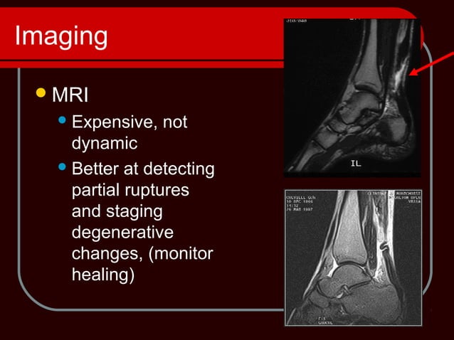 Achilles tendon pathology | PPT