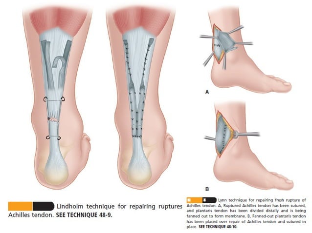 Achilles tendon pathology | PPT