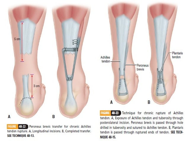 Achilles tendon pathology | PPT