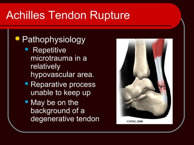 Achilles tendon pathology | PPT
