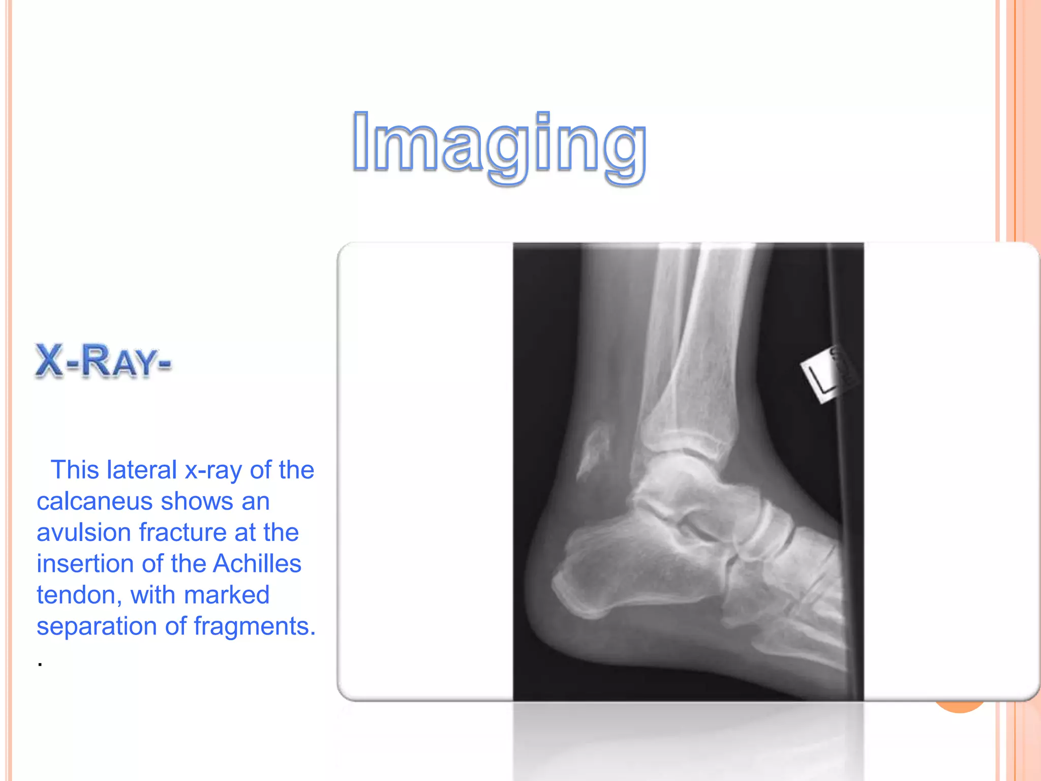 Achilles tendon for presentation | PPTX
