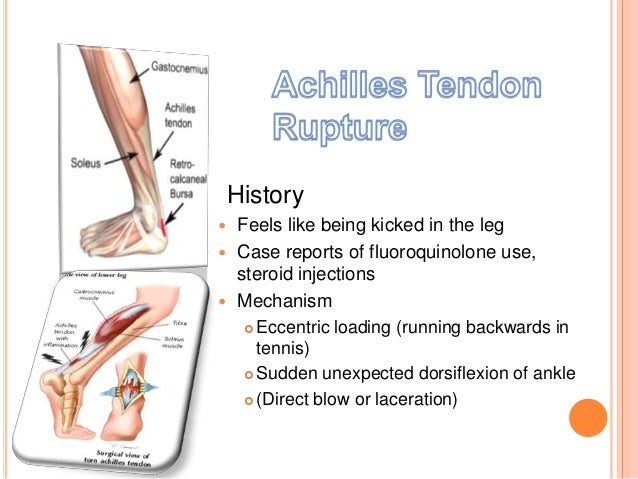 Achilles tendon for presentation