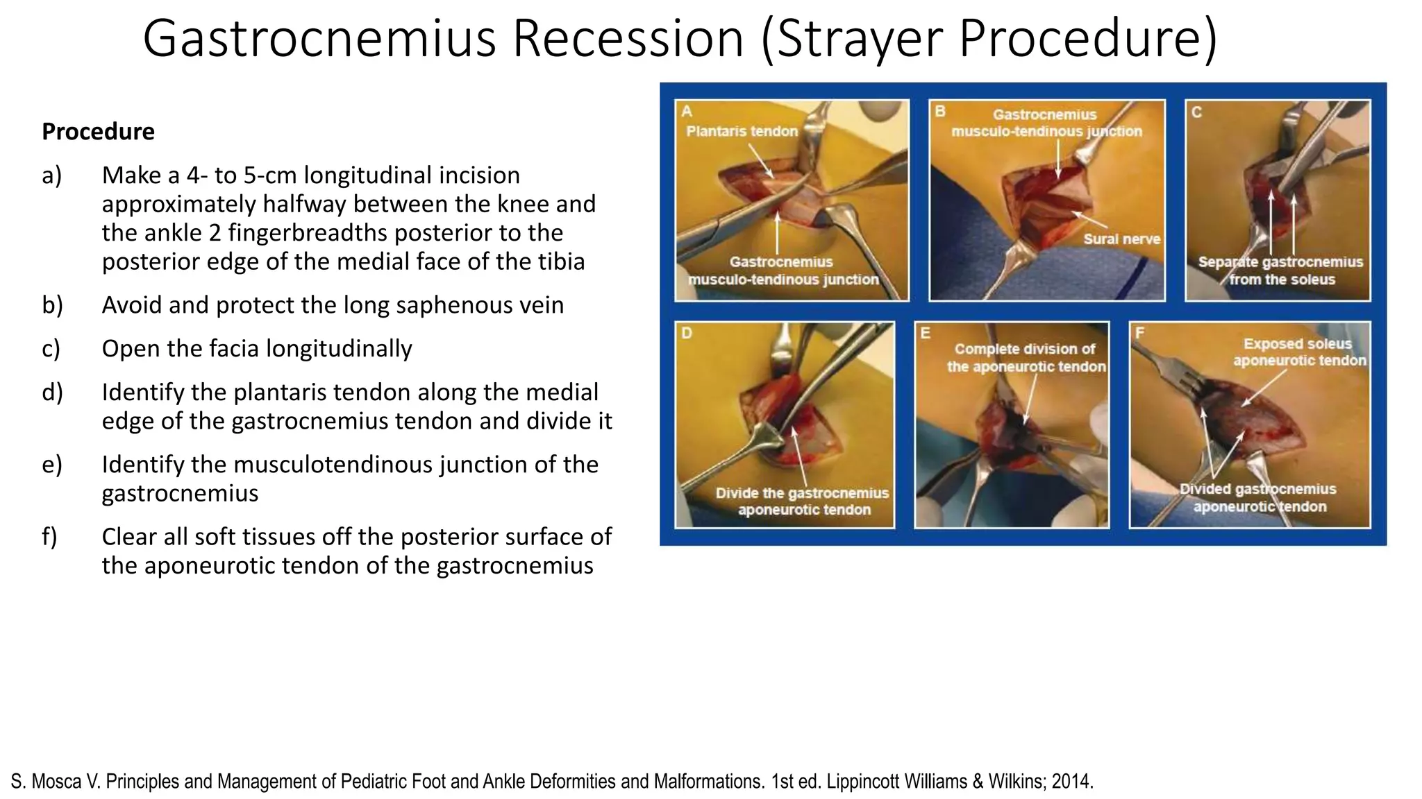 Achilles Tendon Lengthening.pptx